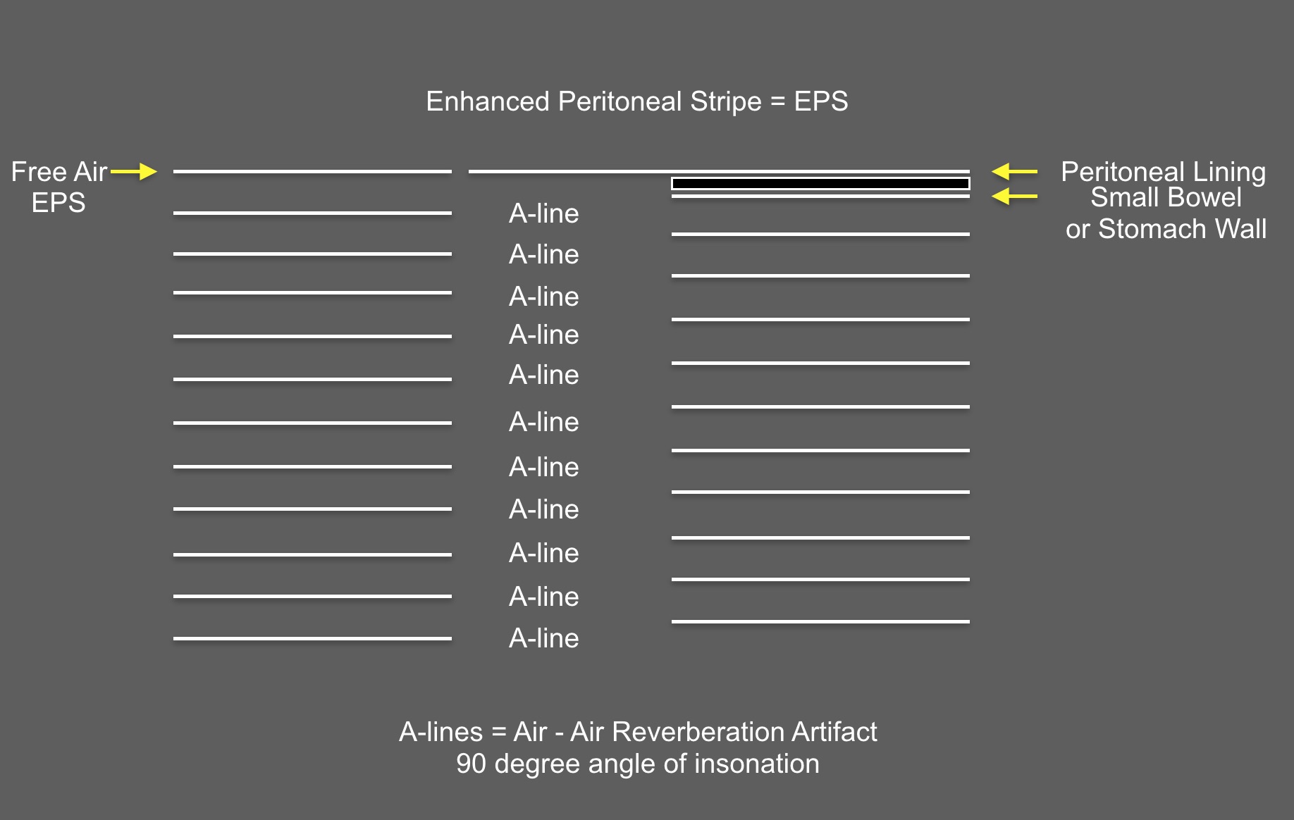 Webinar Short - The AFAST® Detection of Free Air - Pneumoperitoneum