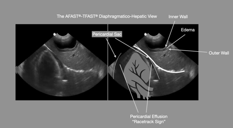 Internal medicine blog: Ultrasound Assessment of the Gallbladder Wall ...