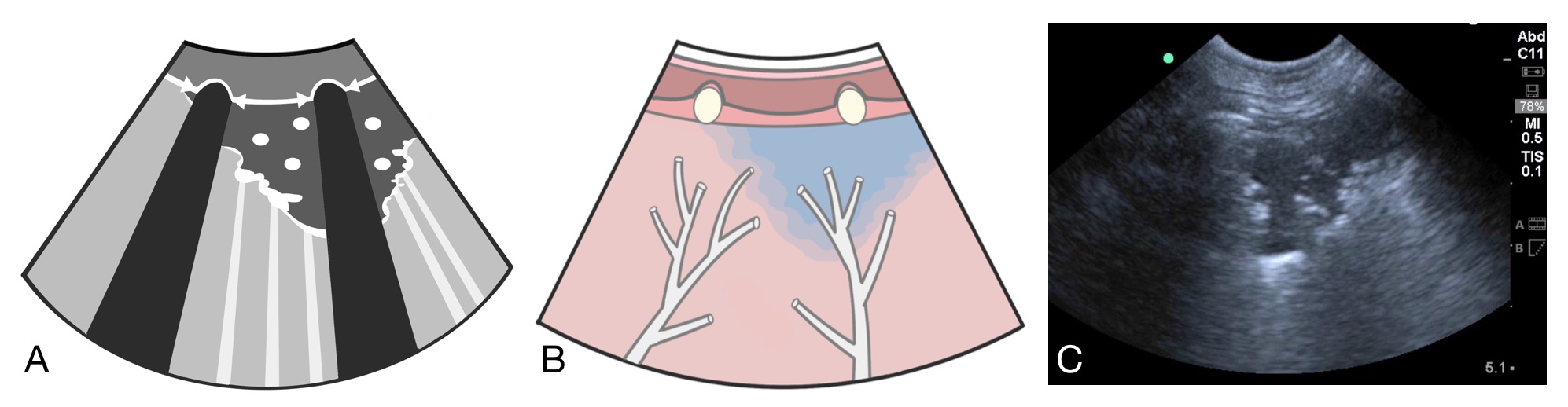 IVECCS 2023 Poster - The Frequency of Aspiration Pneumonia Using the ...