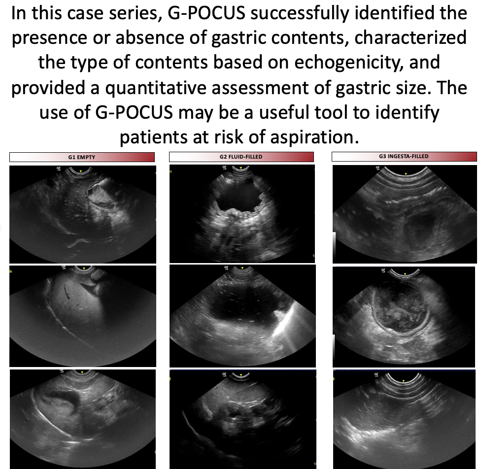 IVECCS 2023 Poster - Gastric POCUS (G-POCUS) Protocol for the ...