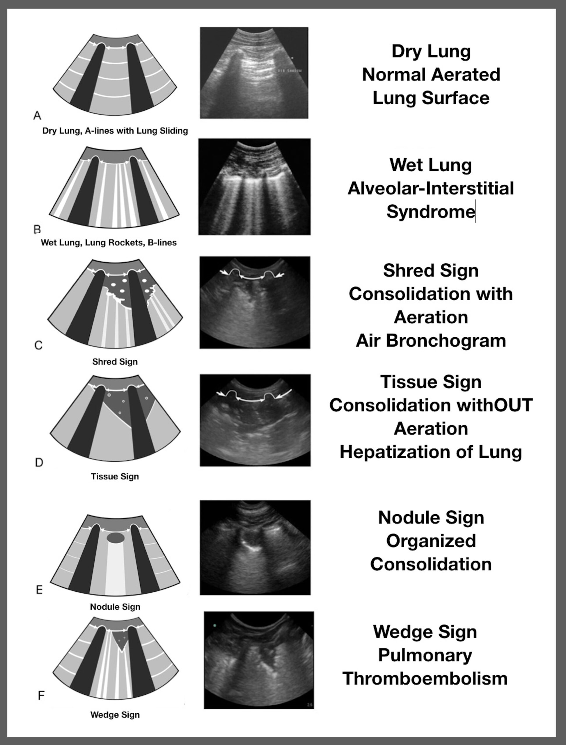 IVECCS 2023 Poster - The Frequency of Aspiration Pneumonia Using the ...